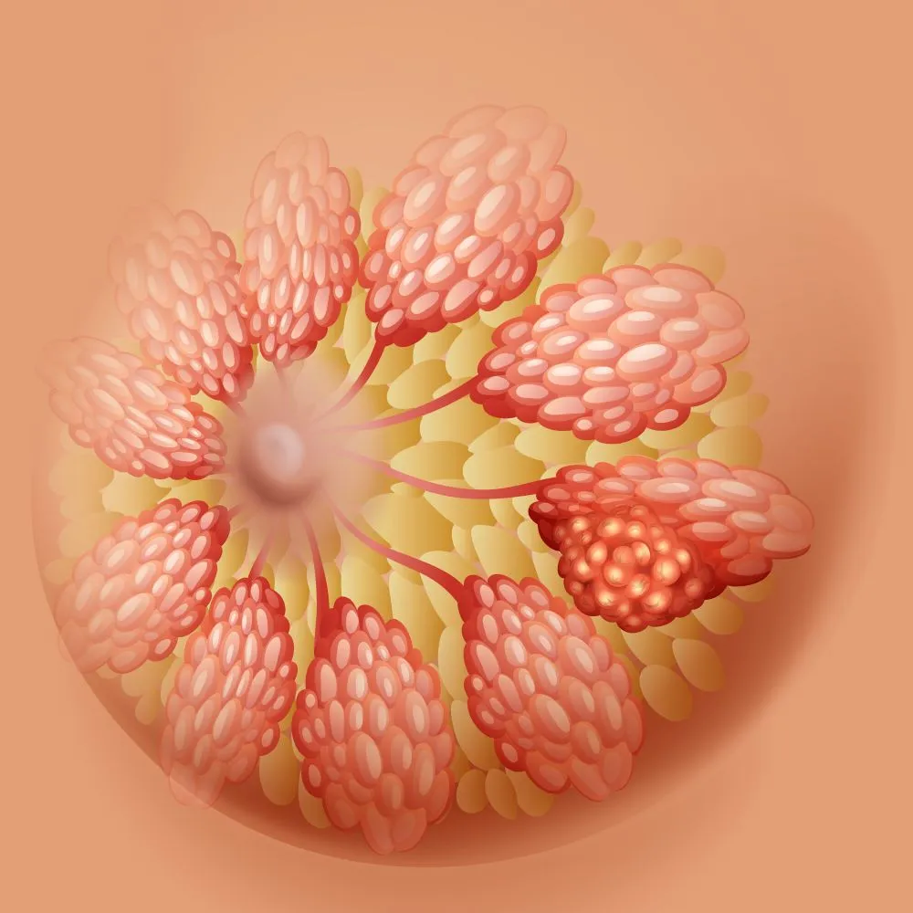 Nódulo Palpável Na Mama: Causas, Diagnóstico E Quando Se Preocupar